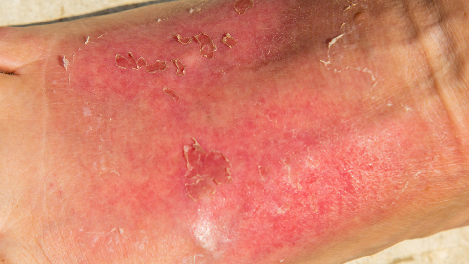 The Sun & Scars: How Does Sunlight Affect The Scar Healing Process ...