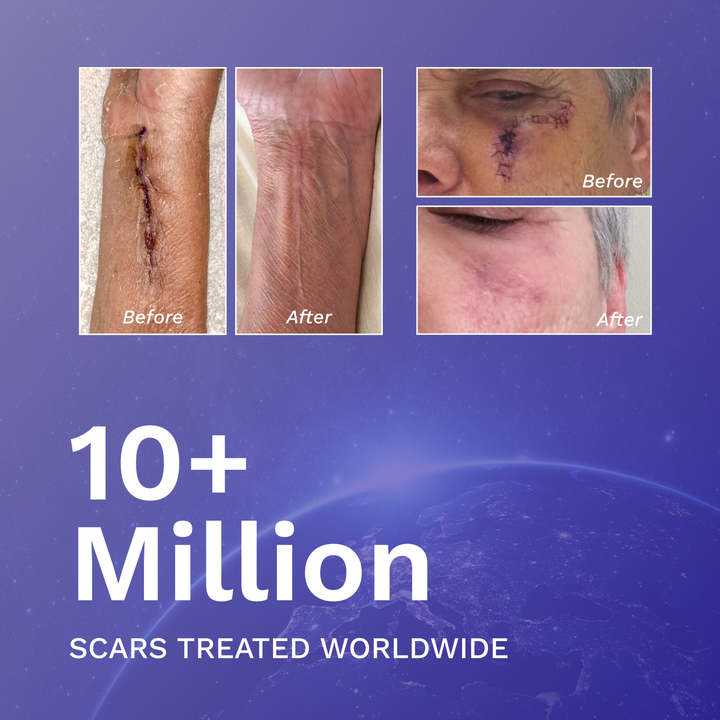 Rejûvaskin Scar Fx Silicone Sheeting - Reduce Scar Appearance